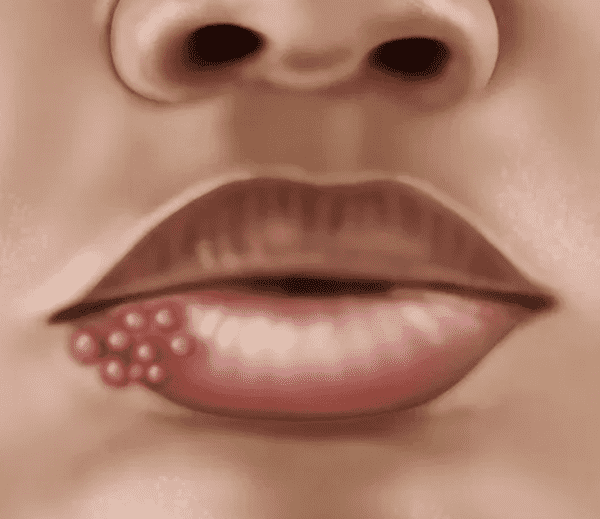 Most Common STDs, Pictures and Descriptions